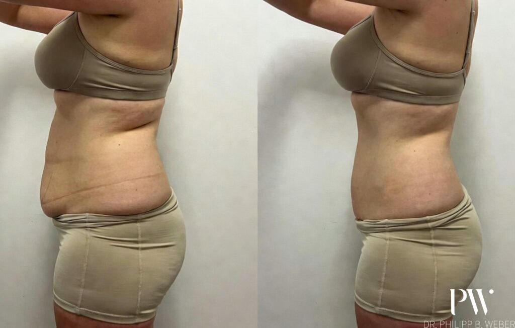 Fett Weg Spritze Vorher Nachher Bauch